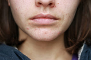 Talgdrüsen verstopft ꟾ FineSkin